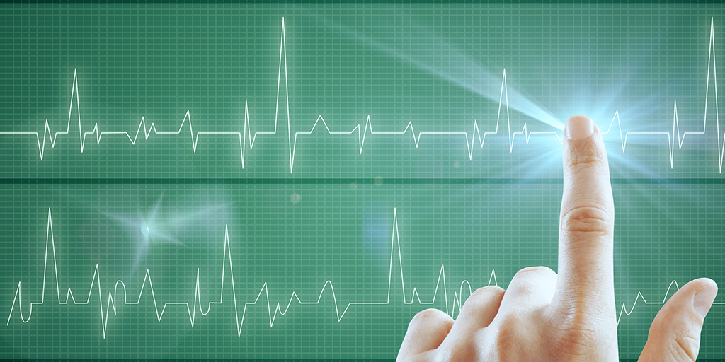Understanding EKG Heart Rhythms